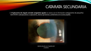 CLASIFICACION DE LAS CATARATAS.pptx