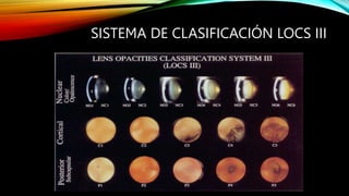 CLASIFICACION DE LAS CATARATAS.pptx