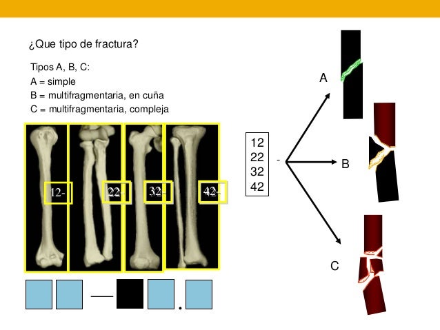 Clasificacion de las fracturas ao