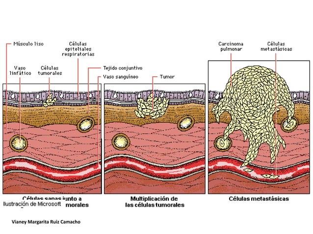 Clasificación de las neoplasias benignas y malignas | PPT Clasificación de las neoplasias benignas y malignas | PPT