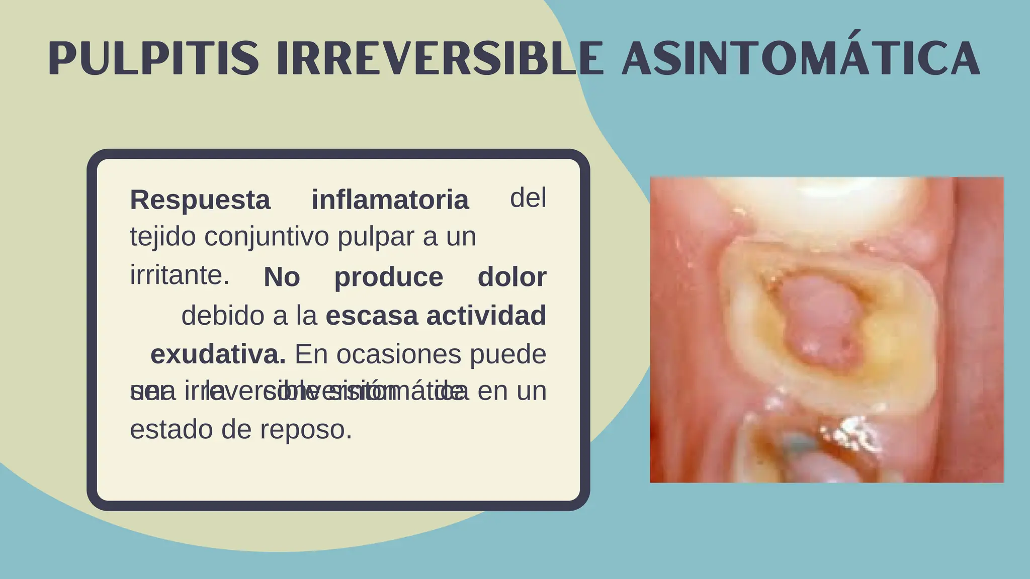 Clasificación e Interpretación de Lesiones Pulpares | PDF | Dental ...