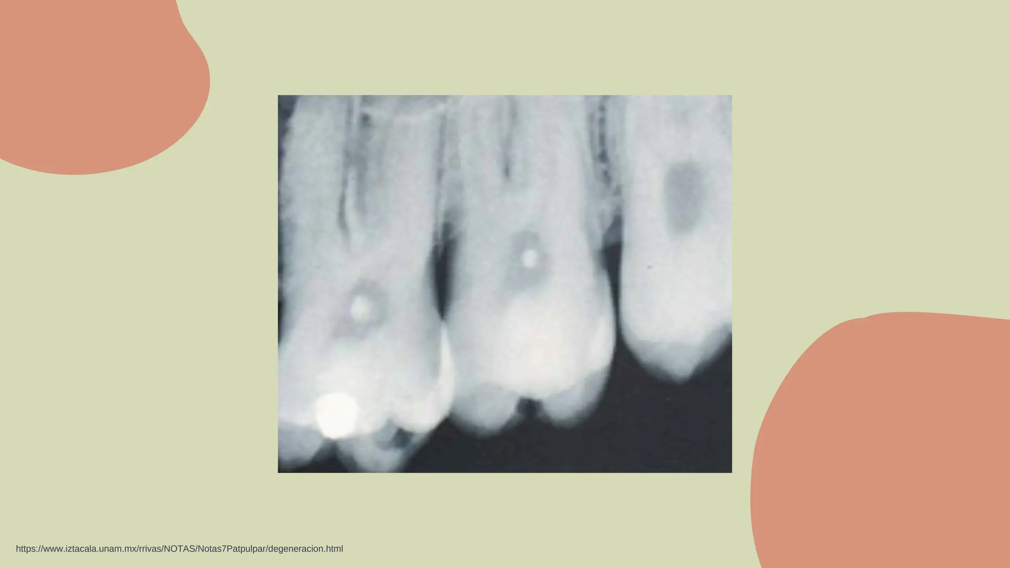 Clasificación e Interpretación de Lesiones Pulpares | PDF | Dental ...