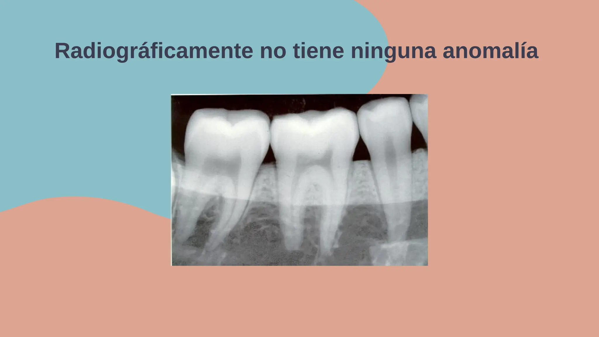 Clasificación e Interpretación de Lesiones Pulpares | PDF | Dental ...