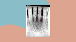 Clasificación e Interpretación de Lesiones Pulpares | PDF | Dental ...
