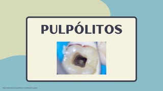 Clasificación e Interpretación de Lesiones Pulpares | PDF | Dental ...