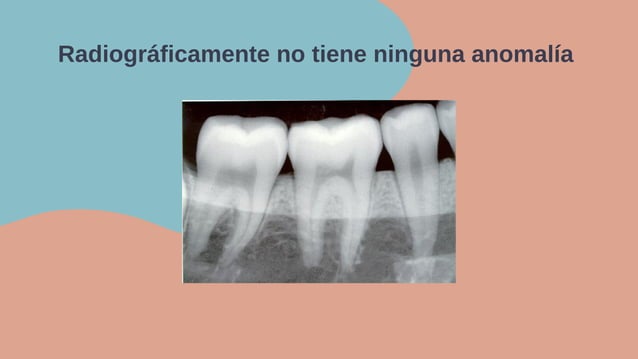 Clasificación e Interpretación de Lesiones Pulpares | PDF | Dental ...