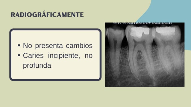 Clasificación e Interpretación de Lesiones Pulpares | PDF | Dental ...