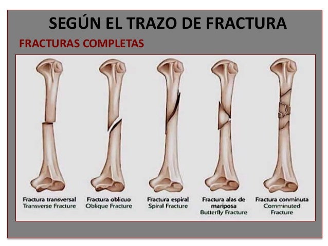 Clasificacion fracturas