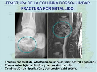 Clasificacion fracturas cervicales1 | PPT