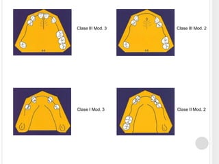 Clasificacion kennedy | PPTX