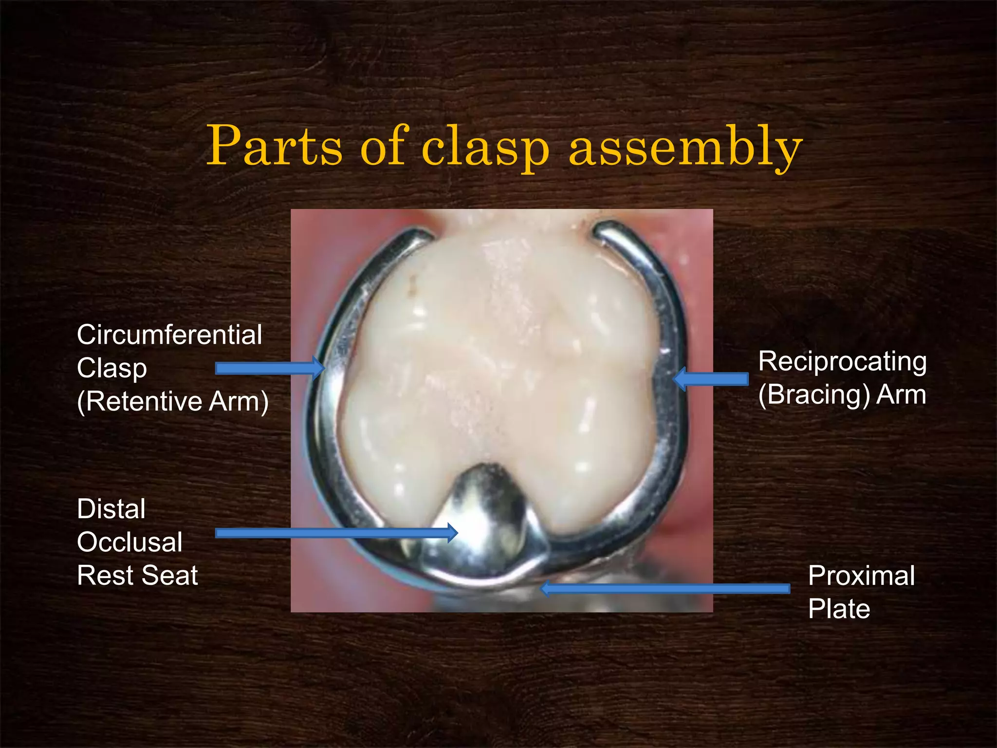 Clasp Designs - Dr. devi | PPTX