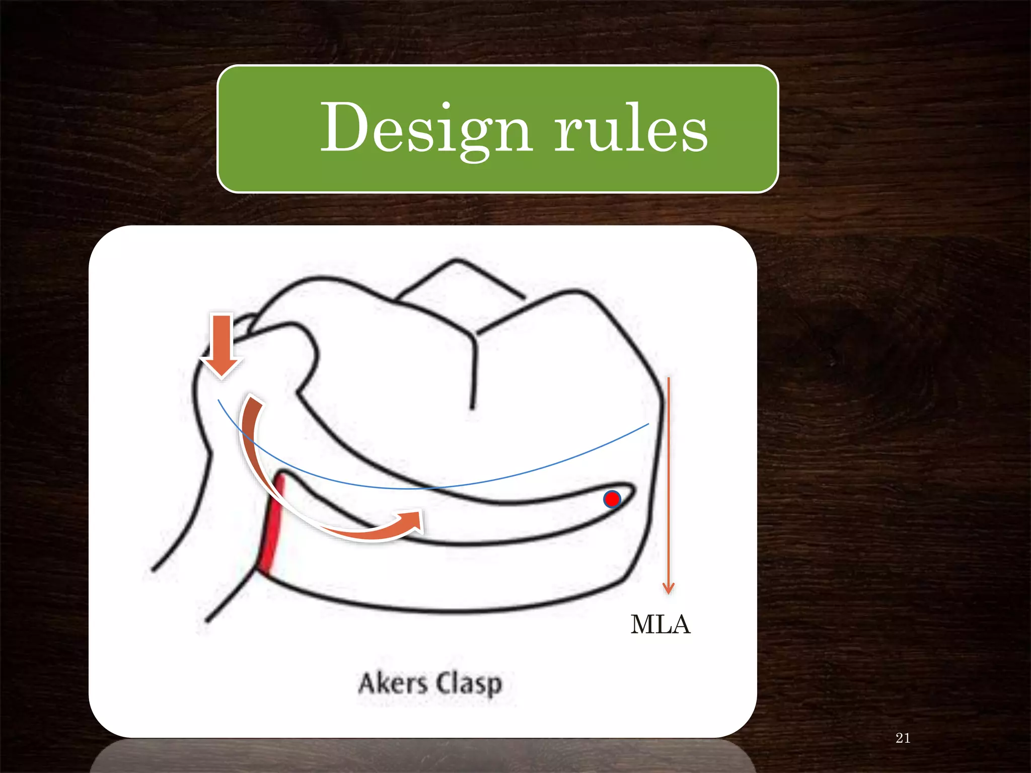 Clasp Designs - Dr. devi | PPTX