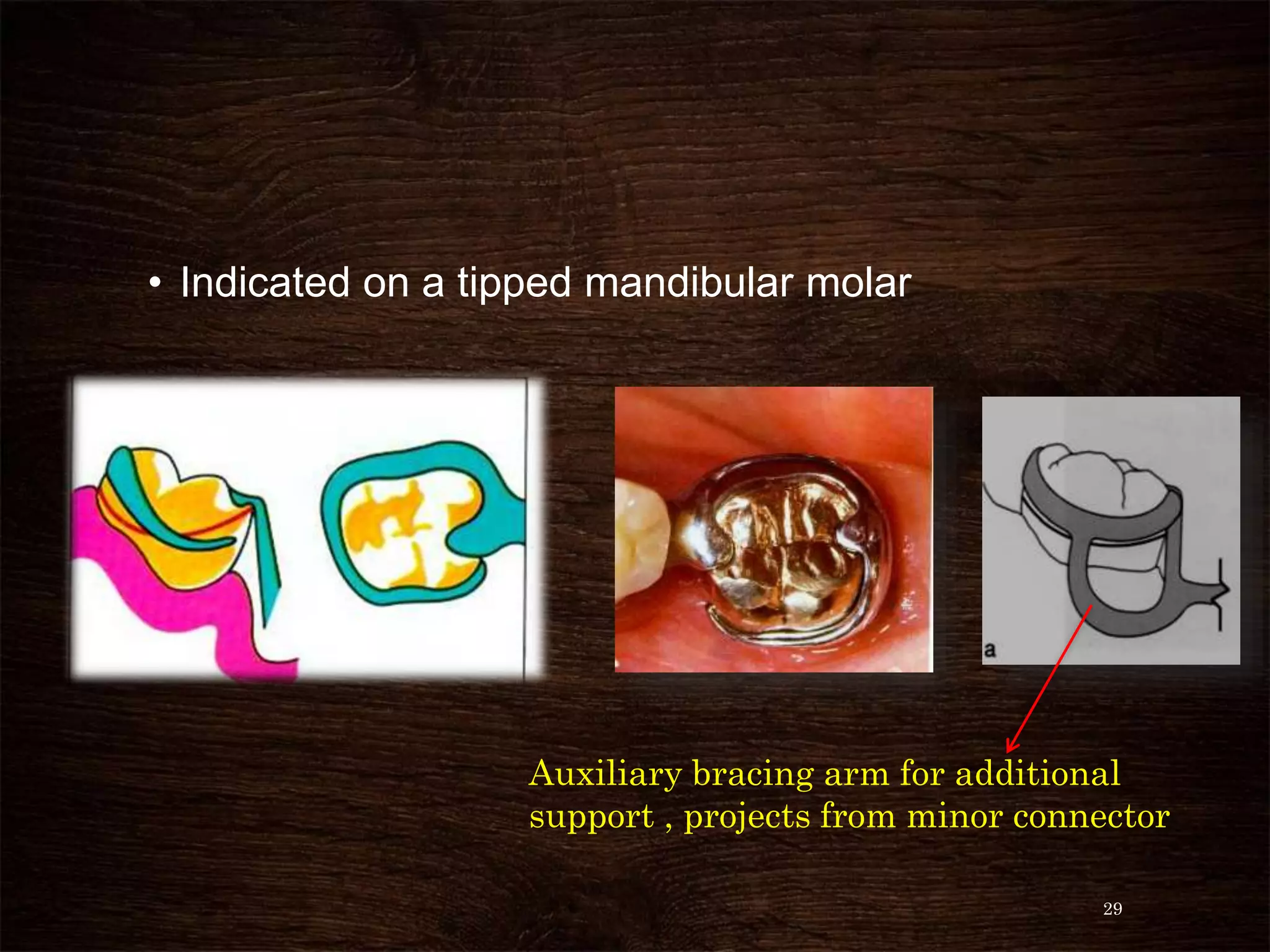 Clasp Designs - Dr. devi | PPTX