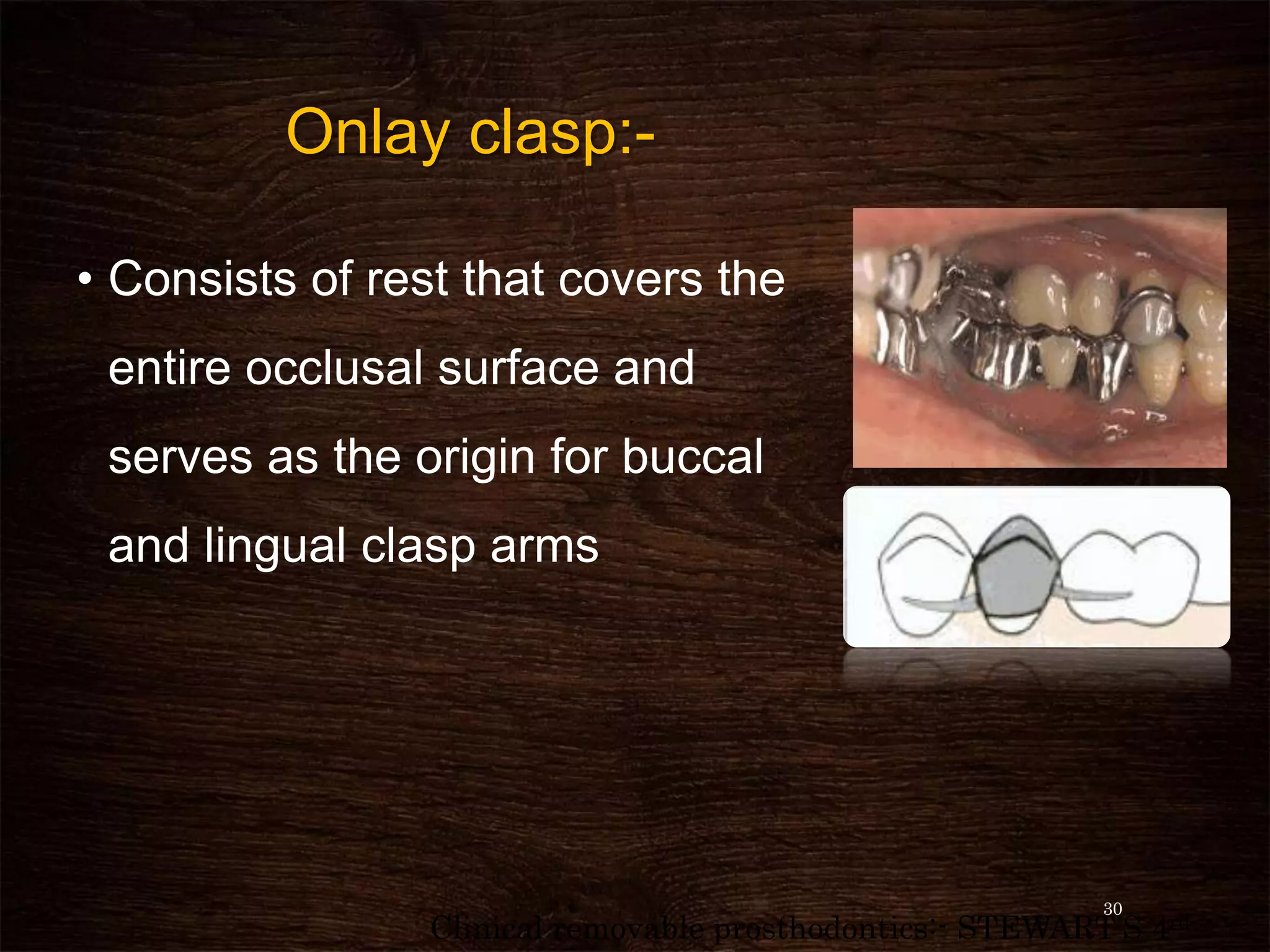 Clasp Designs - Dr. devi | PPTX