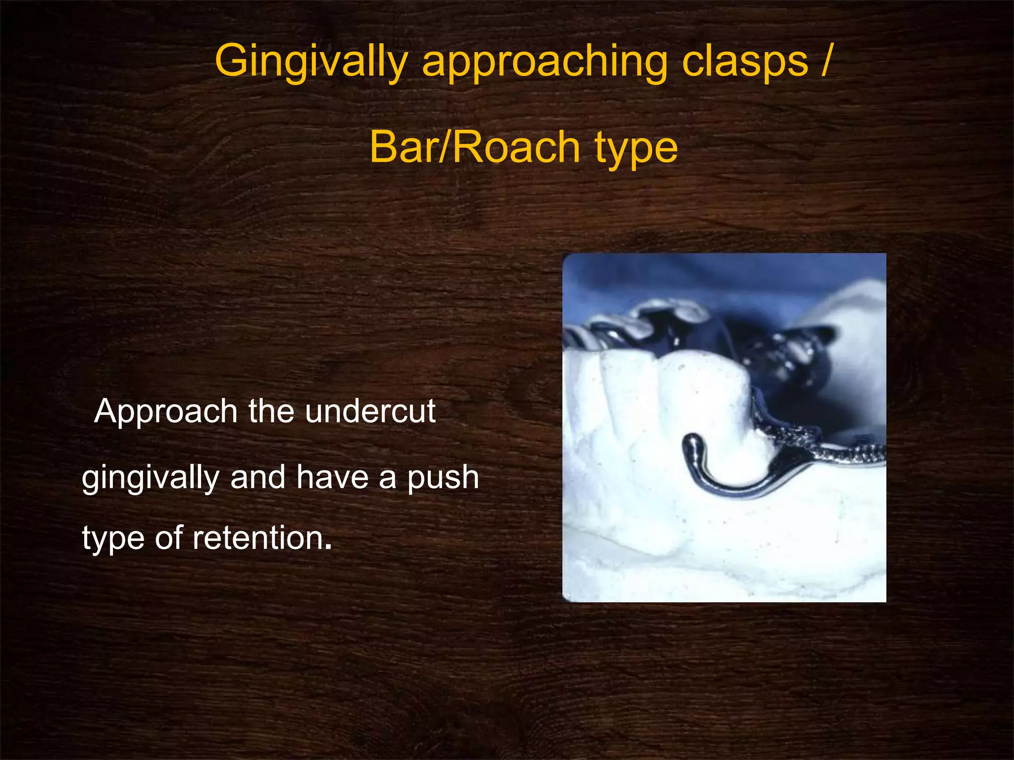 Clasp Designs - Dr. devi | PPTX