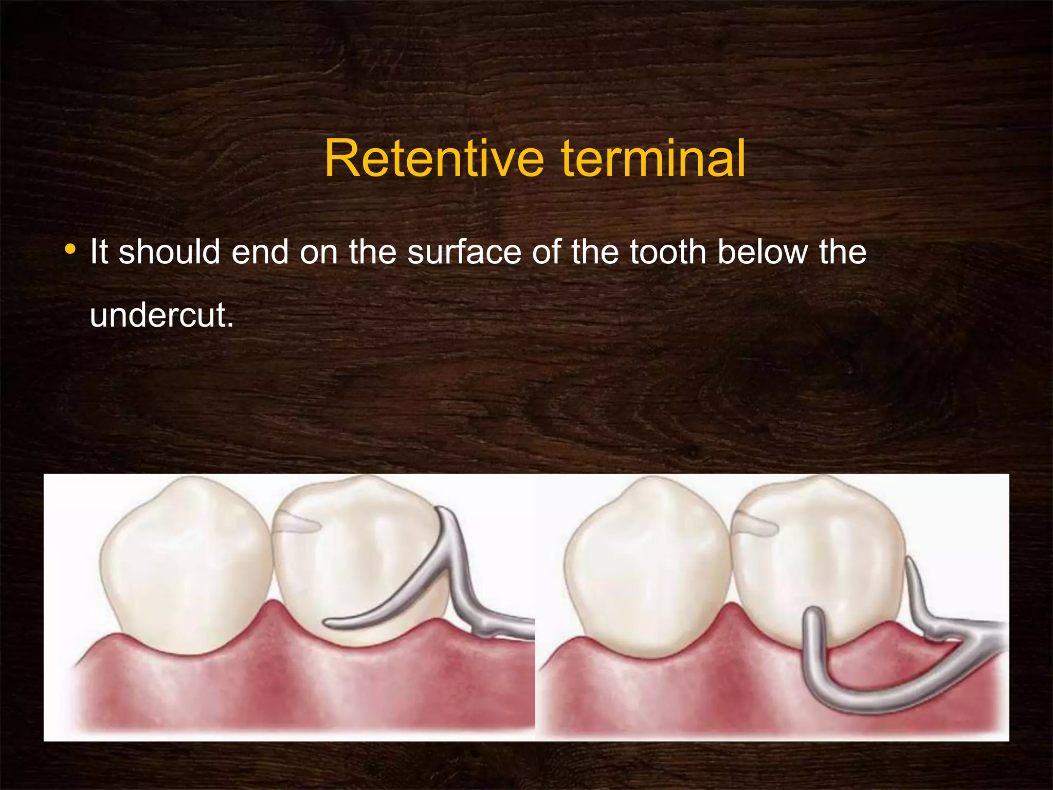 Clasp Designs - Dr. devi | PPTX