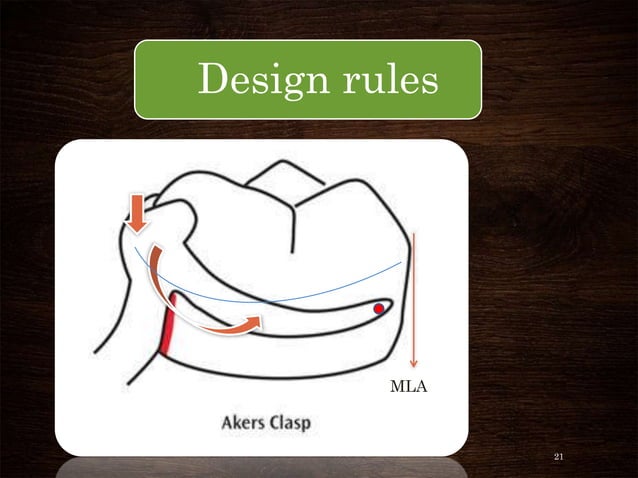 Clasp Designs - Dr. devi | PPTX