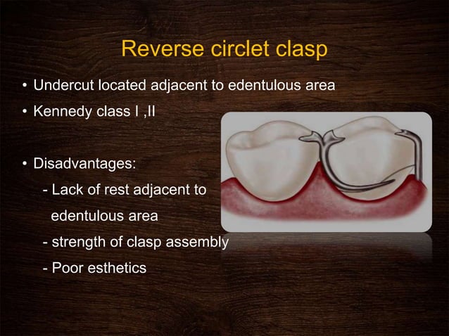 Clasp Designs - Dr. devi | PPTX