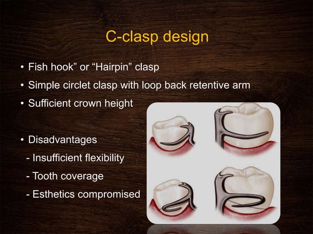 Clasp Designs - Dr. devi | PPTX