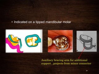 Clasp Designs - Dr. devi | PPTX