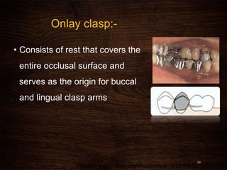 Clasp Designs - Dr. devi | PPTX