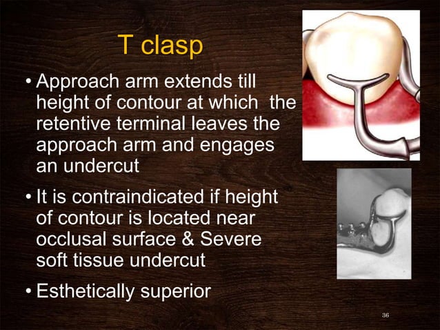 Clasp Designs - Dr. devi | PPTX