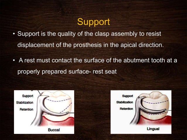 Clasp Designs - Dr. devi | PPTX