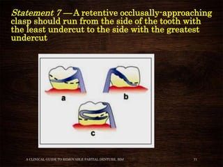 Clasp Designs - Dr. devi | PPTX