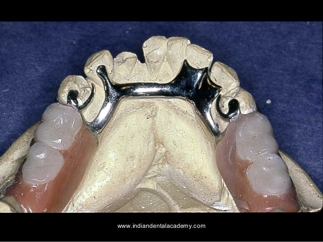 Clasp Ret Rpd Certified Fixed Orthodontic Courses By Indian Dental A…
