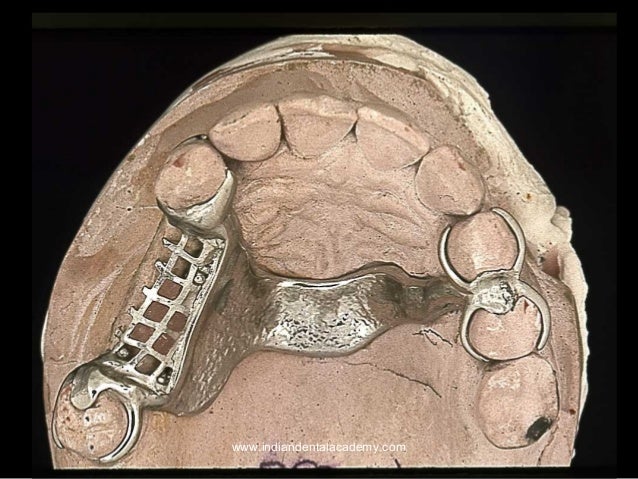 Clasp Ret Rpd Certified Fixed Orthodontic Courses By Indian Dental A…