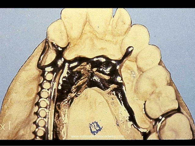 Clasp ret rpd /certified fixed orthodontic courses by Indian dental a…