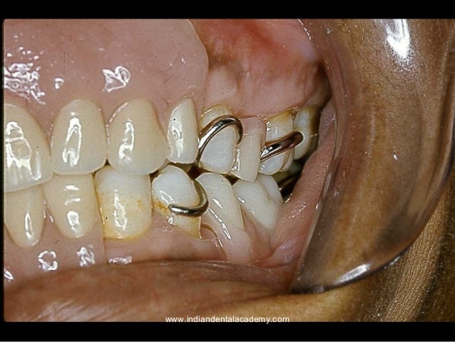 Clasp ret rpd /certified fixed orthodontic courses by Indian dental a…