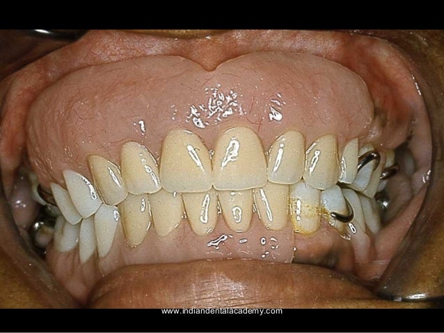 Clasp ret rpd /certified fixed orthodontic courses by Indian dental a…