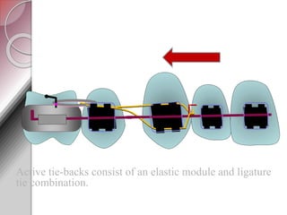 Biomechanics in Orthodontics | PPTX