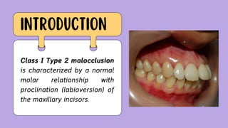 Managemnt of Class 1 Type-2-Malocclusion.pdf