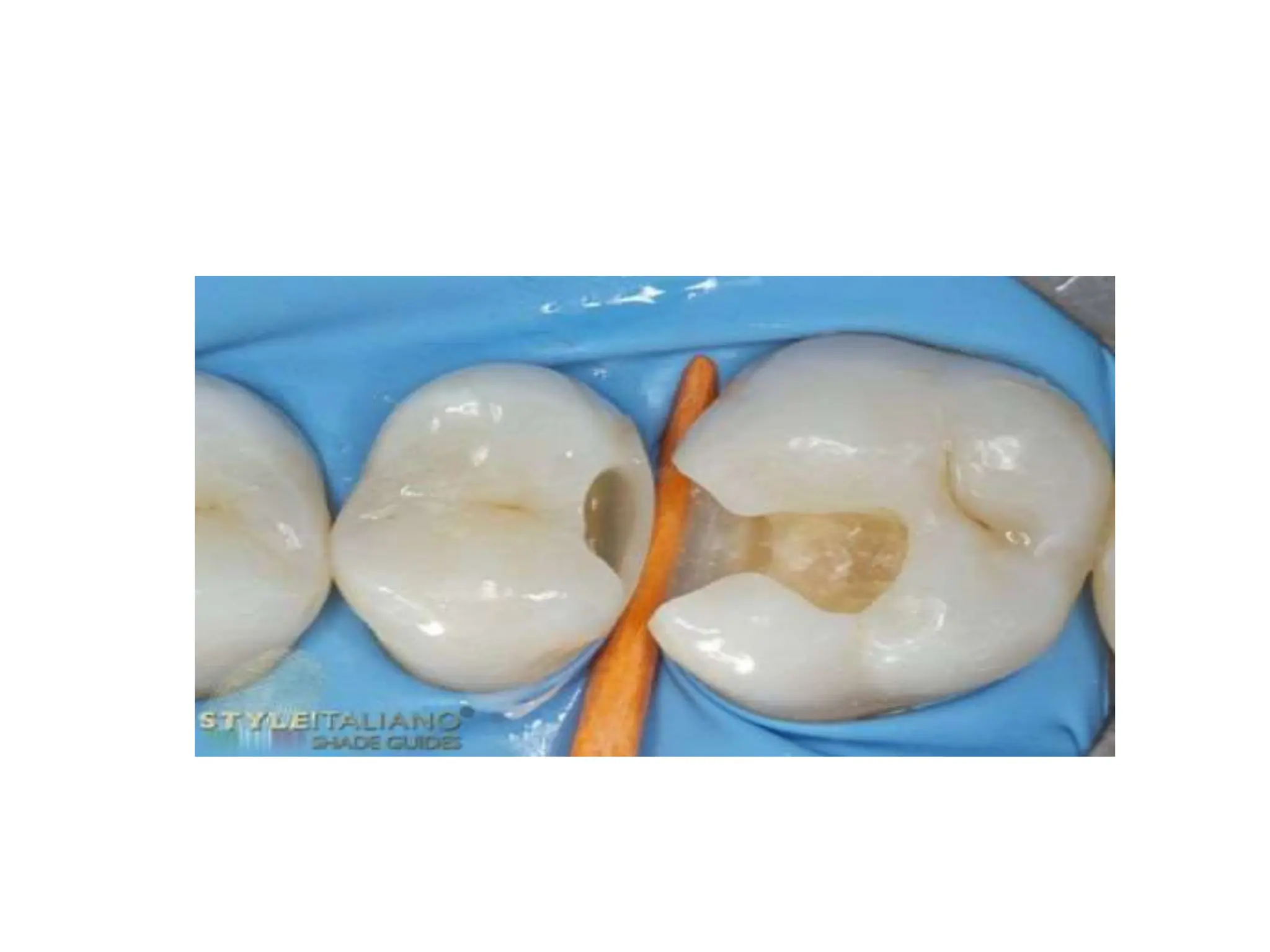 Class-II-cavity-preparation.pptx