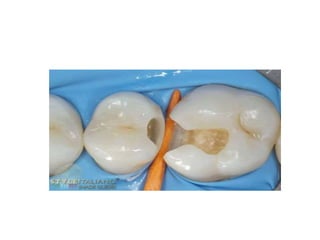 Class-II-cavity-preparation.pptx