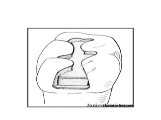 Class-II-cavity-preparation.pptx