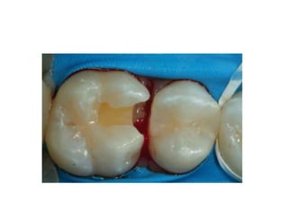 Class-II-cavity-preparation.pptx