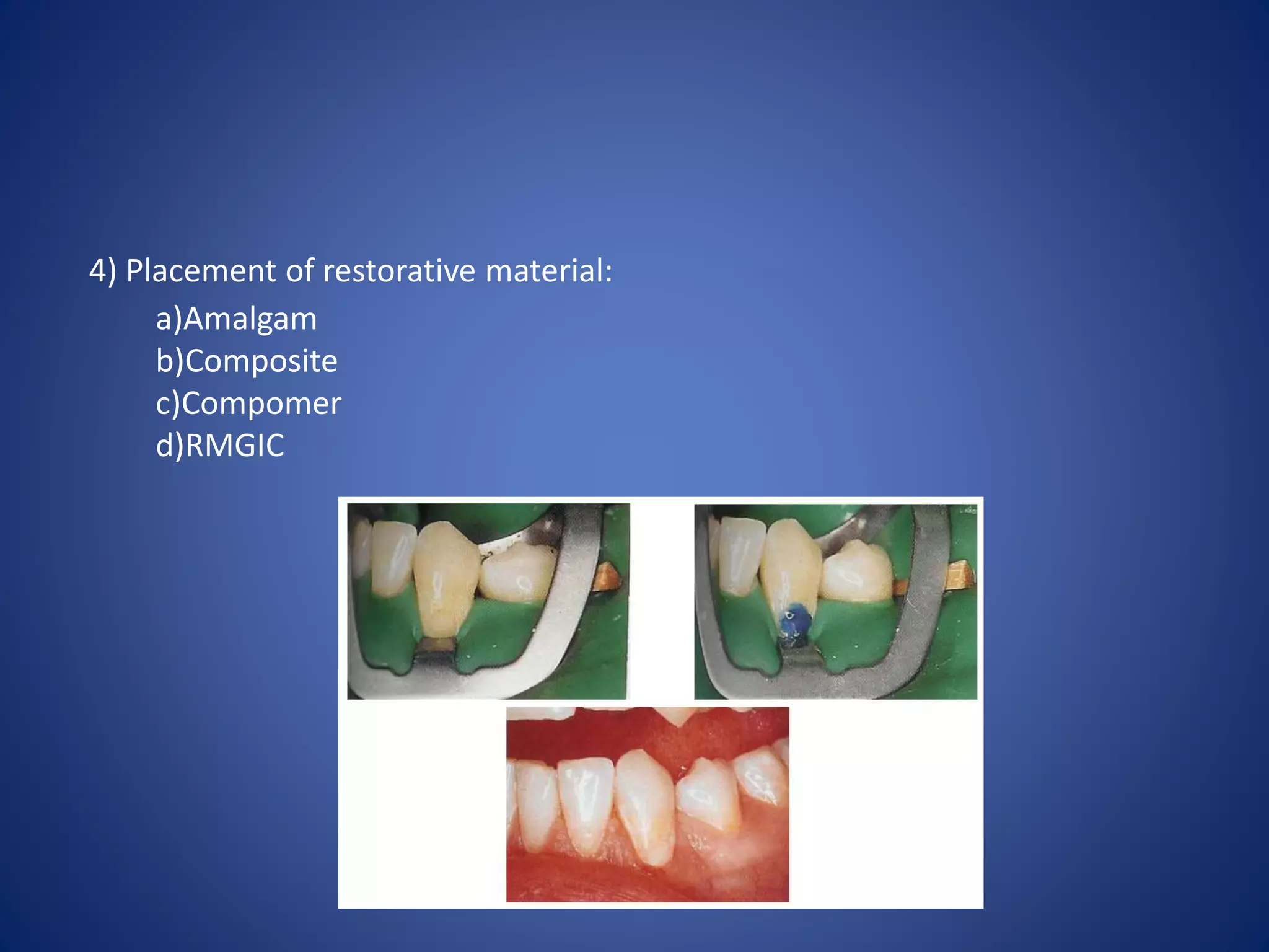 Class v-restoration - Operative | PPTX