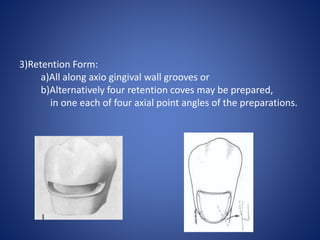 Class v-restoration - Operative | PPTX