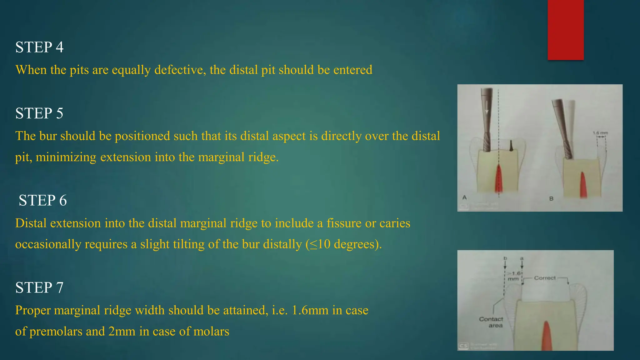 Class 1 and 2 amalgam tooth preparation. | PDF