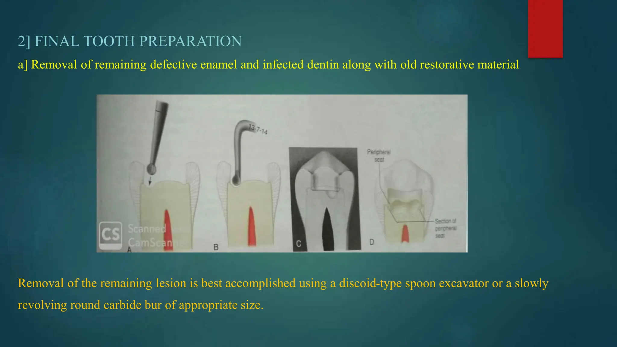 Class 1 and 2 amalgam tooth preparation. | PDF
