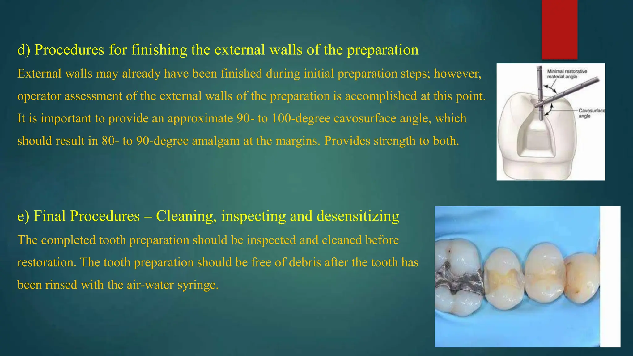 Class 1 and 2 amalgam tooth preparation. | PDF