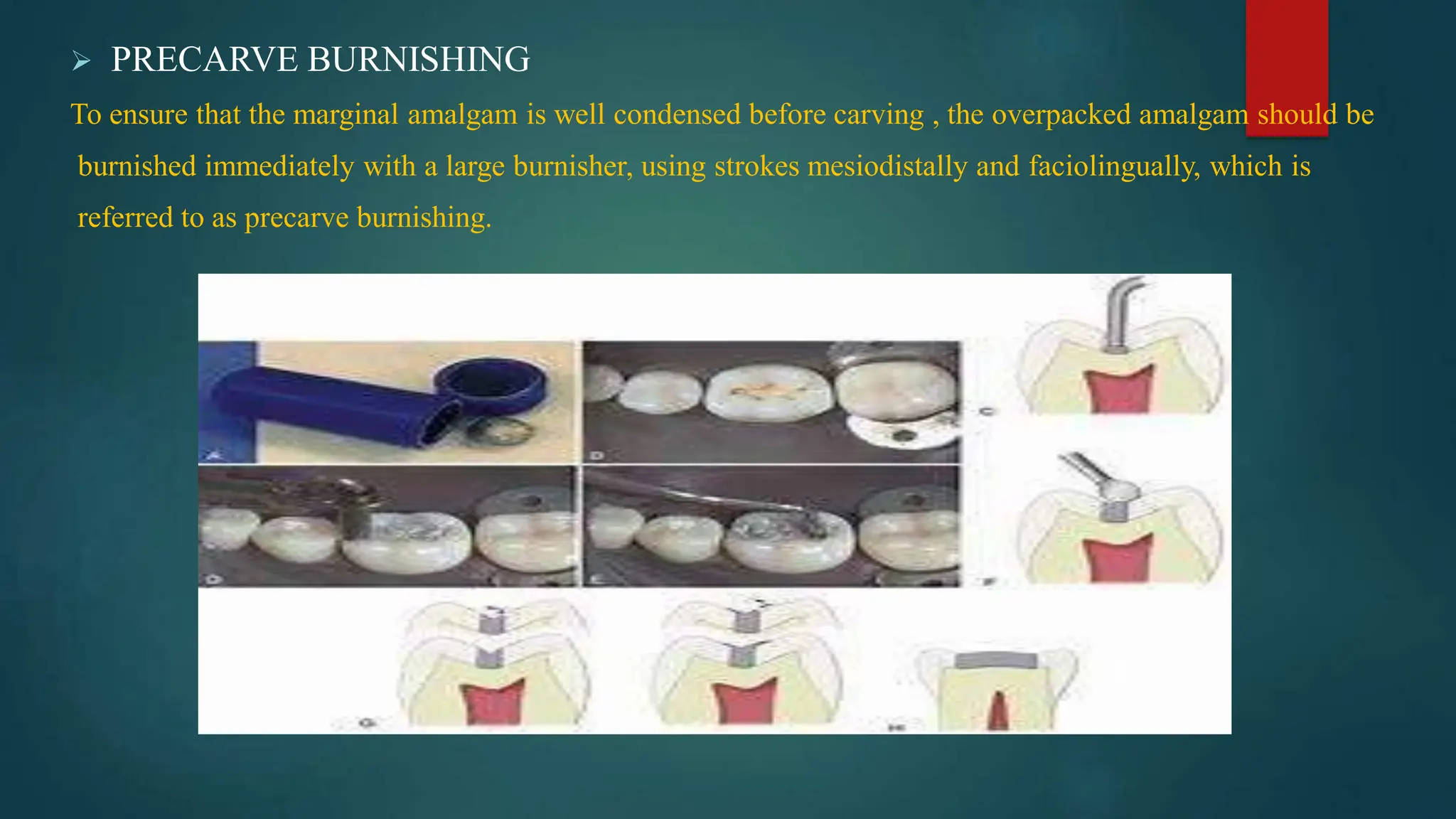 Class 1 and 2 amalgam tooth preparation. | PDF