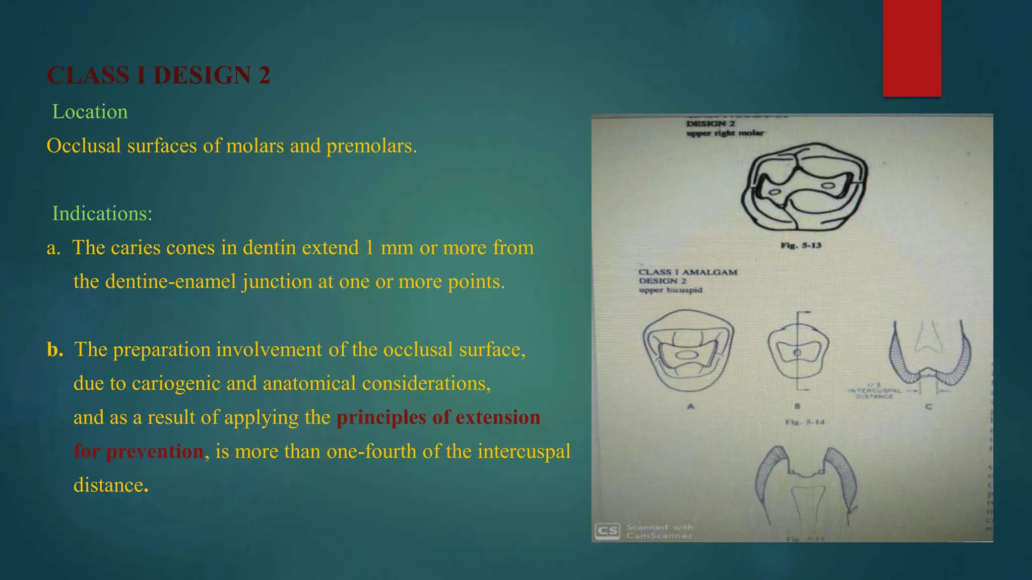 Class 1 and 2 amalgam tooth preparation. | PDF