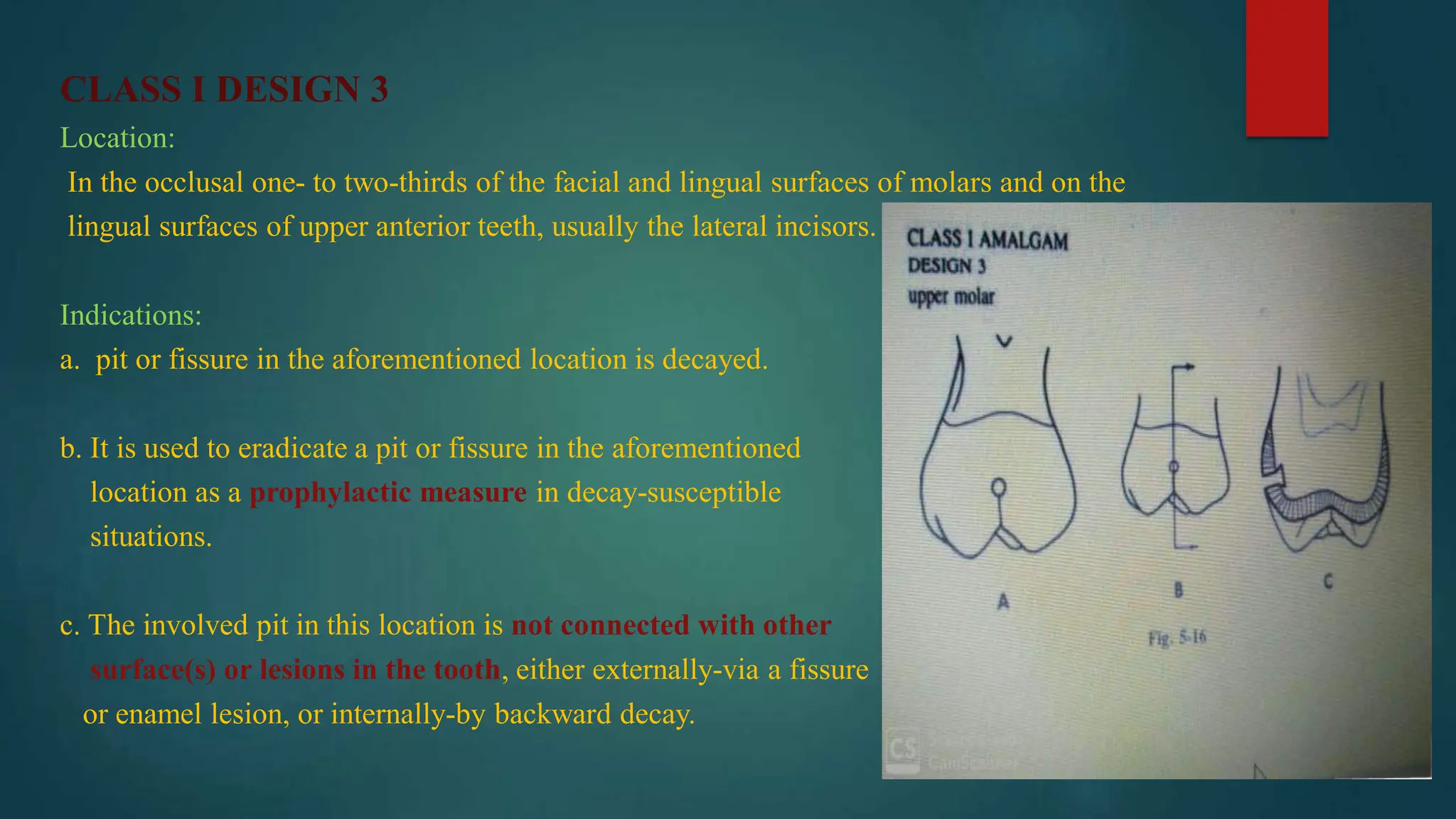 Class 1 and 2 amalgam tooth preparation. | PDF