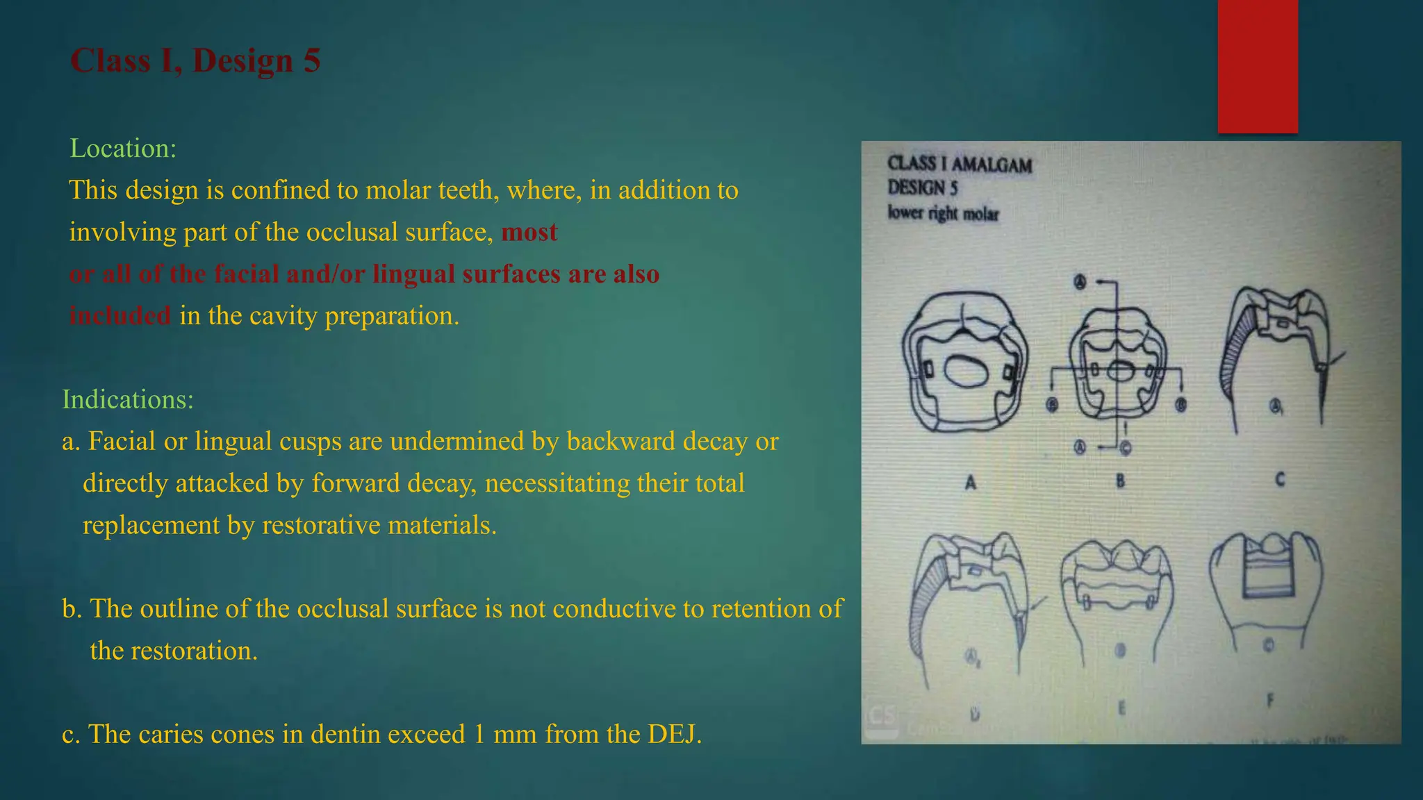 Class 1 and 2 amalgam tooth preparation. | PDF