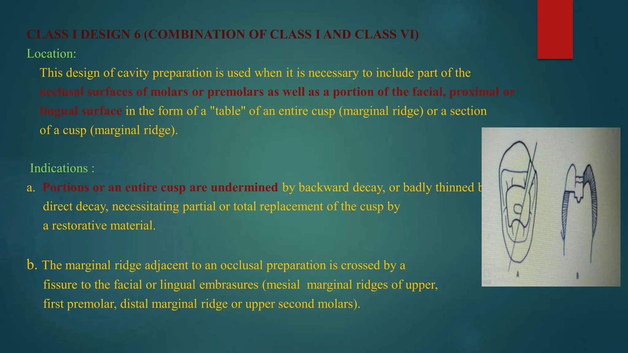 Class 1 and 2 amalgam tooth preparation. | PDF