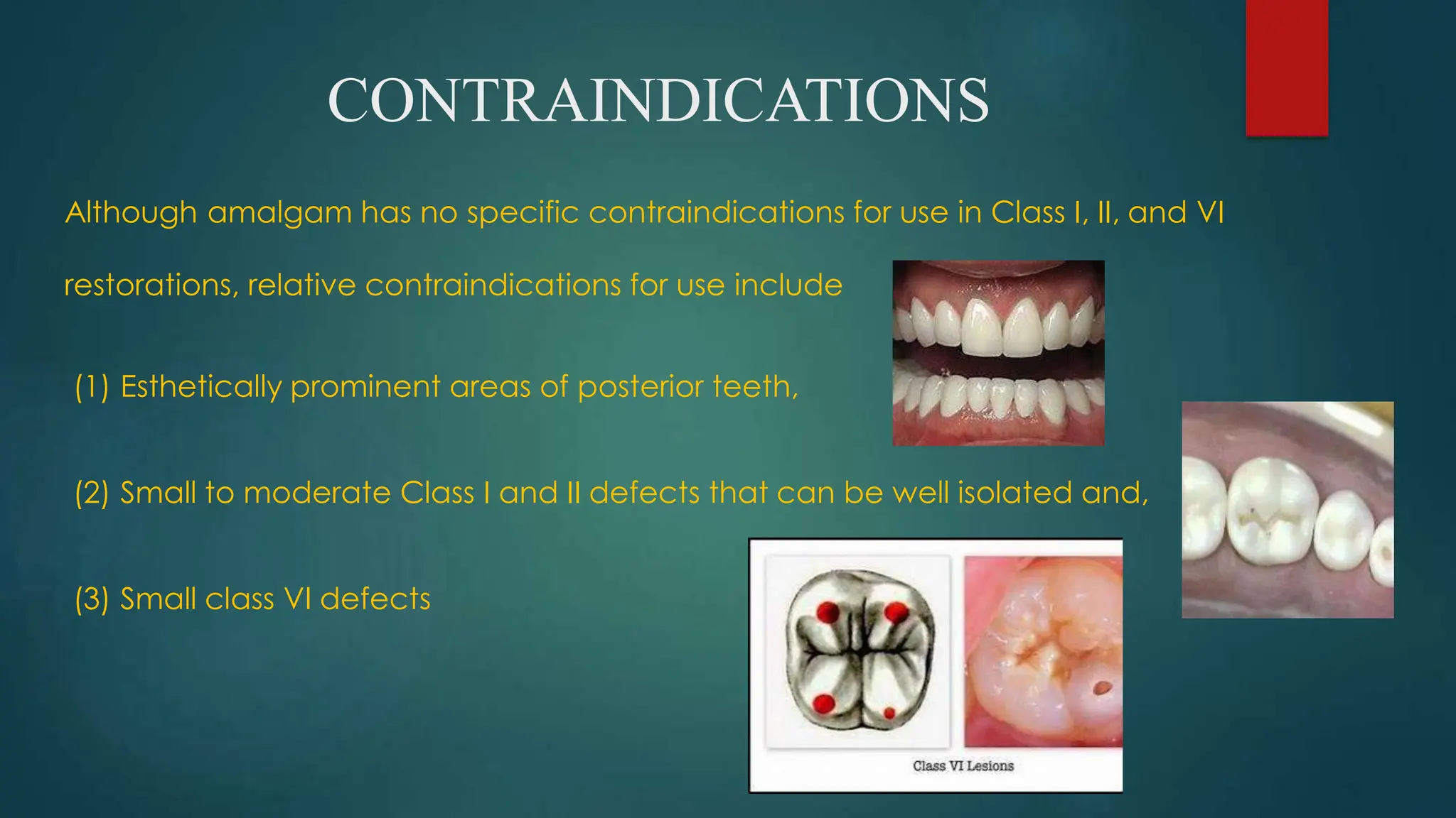 Class 1 and 2 amalgam tooth preparation. | PDF